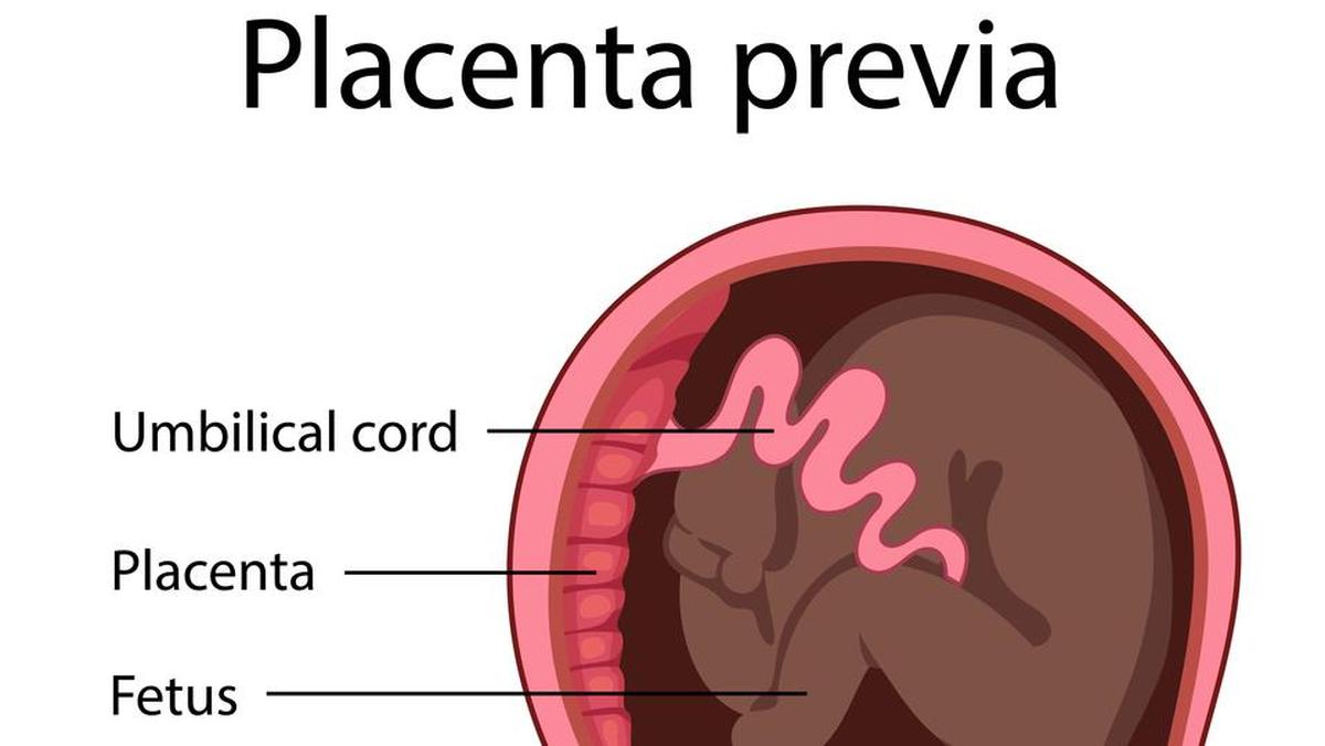 Plasenta Previa: Jenis, Penyebab, Gejala, dan Cara Mencegahnya