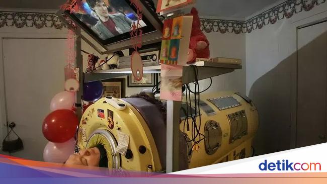 Akhir Kisah Pengidap Polio yang Hidup dengan Paru-paru Besi gegara Mati ...