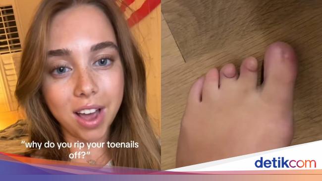 Langka Banget Wanita Ini Tak Punya Kuku Kaki