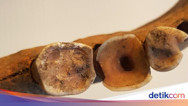 Orang Viking di Abad ke-10 Sudah Lakukan Perawatan Gigi yang Rumit ...