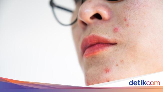 Muncul Jerawat di Atas Bibir? Ini Penyebab dan Cara Mengatasinya