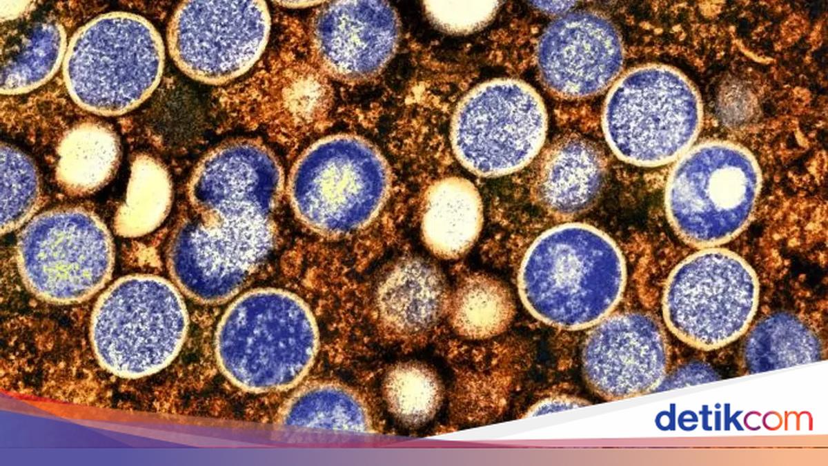 Ancaman Ngeri Virus Misterius Alaskapox, Pahami Gejala dan Pencegahannya