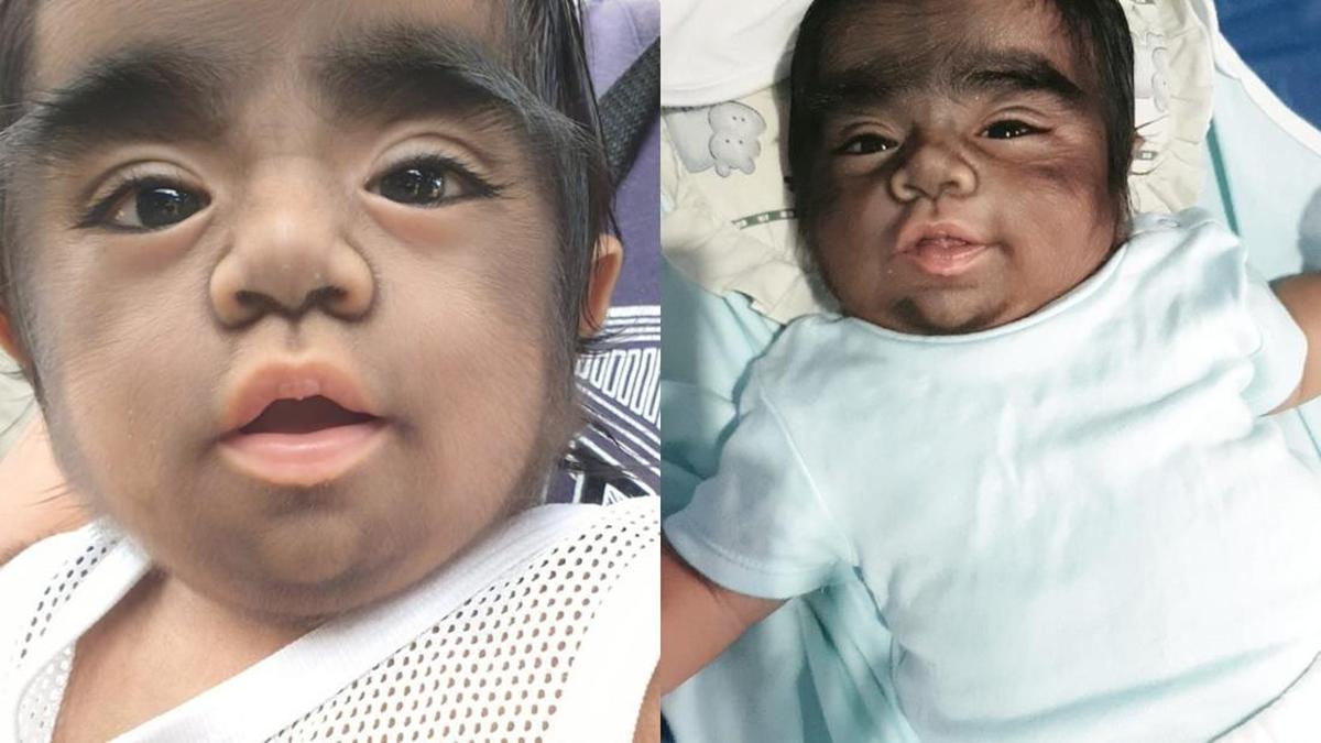 Viral Bocah 2 Tahun Idap 'Sindrom Manusia Serigala', Sekujur Tubuh ...