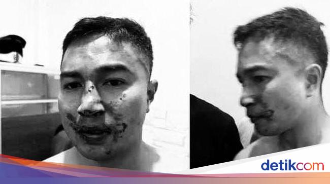Penampakan Wajah Nakes Babak Belur Diduga Dianiaya Oknum Polisi di ...