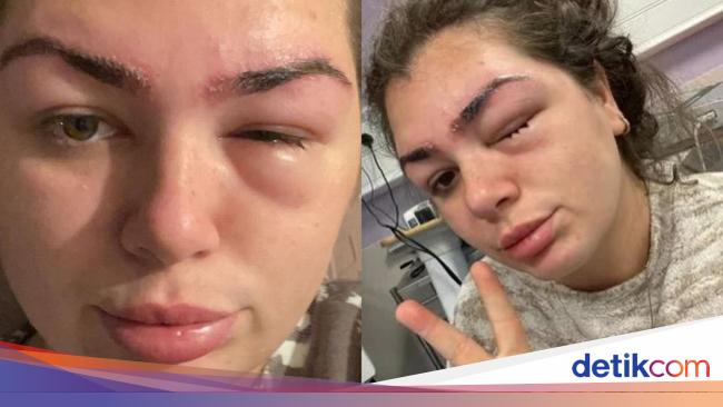 Usai Sulam Alis, Mata Kiri Danielle Tak Bisa Melihat hingga Terancam Buta