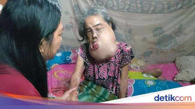 Tolong! Lansia Penderita Tumor Ganas di Polman Butuh Bantuan Berobat Tolong! Lansia Penderita Tumor Ganas di Polman Butuh Bantuan Berobat