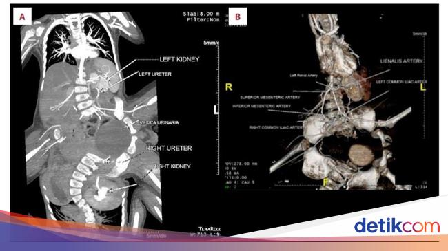Kembar Siam 'Laba-laba' Lahir di Jabar, Punya 3 Kaki dan 4 Tangan