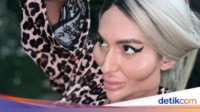 Foto Before After Wanita Pemilik Pipi Terbesar di Dunia, Dulu Tampil Normal