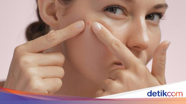 5 Cara Mengatasi Jerawat Hormonal, Dari Skincare hingga Pola Hidup