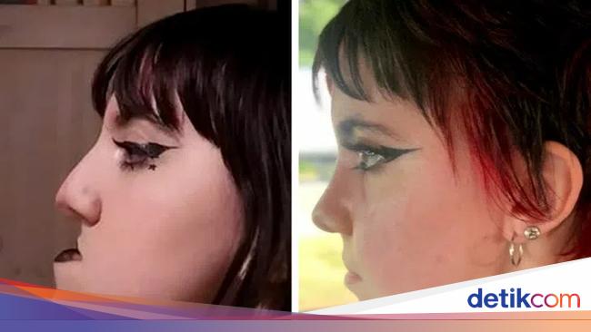 Foto Sebelum dan Sesudah Operasi Plastik Bikin Tercengang