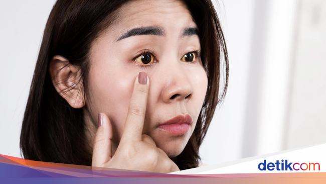 Risiko Komplikasi dari Hepatitis: Penyakit Kuning-Gagal Hati