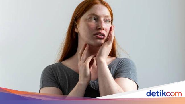 Penyakit Lupus: Gejala, Penyebab, Jenis, hingga Perawatannya