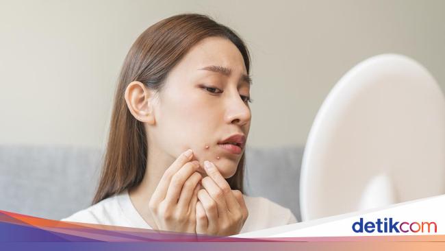 6 Cara Efektif Mengatasi Beruntusan Menurut Dermatologis