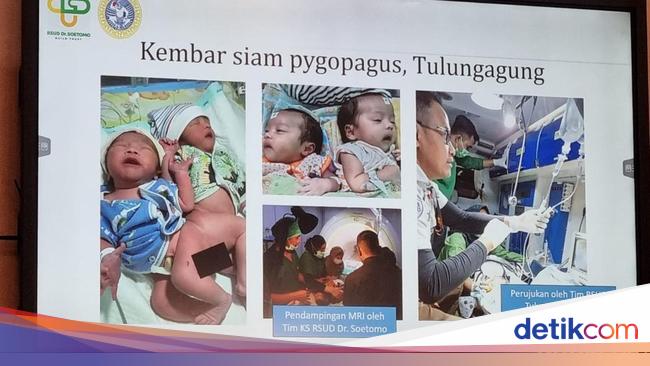 5 Fakta Kembar Siam Dempet Pantat Alami Pneumonia Sebelum Operasi Pemisahan