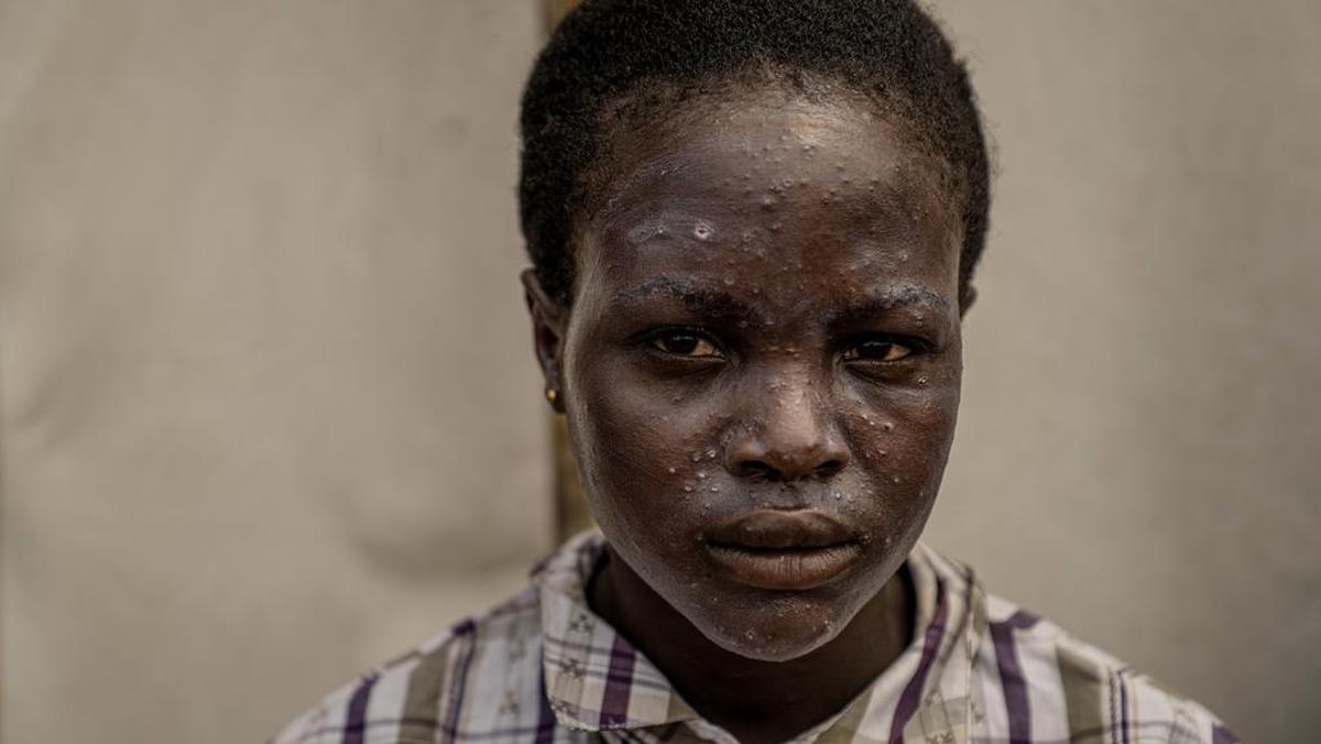 Fakta-fakta Mpox di Afrika Nyaris Tembus 30 Ribu Kasus, Inikah yang ...