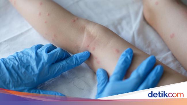 Kemenkes Segera Terbitkan Surat Edaran Waspada Cacar Air dan Gondongan ... Kemenkes Segera Terbitkan Surat Edaran Waspada Cacar Air dan Gondongan ...