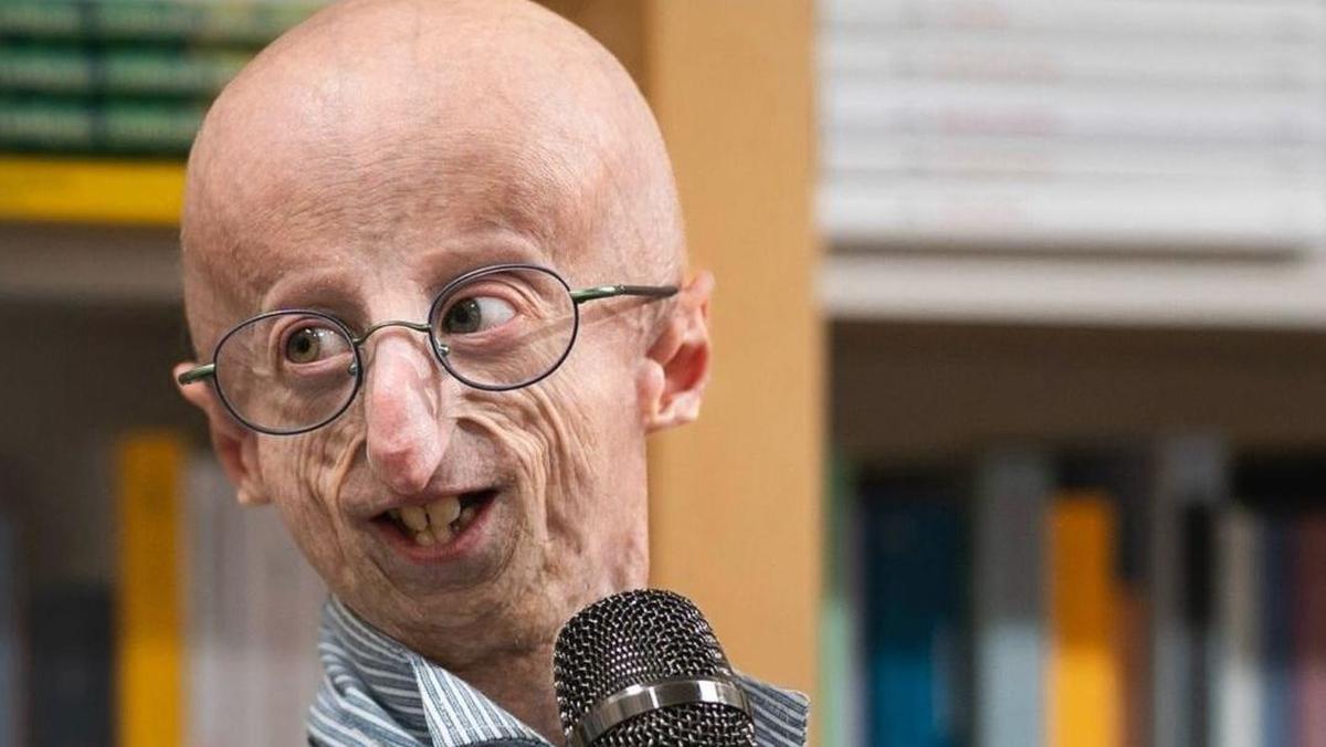 Dialami Sammy Basso, Kenali Penyakit Progeria yang Bikin Pengidapnya ...