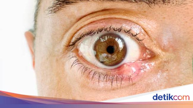 Kenali Kalazion, Benjolan di Kelopak Mata yang Mirip Bintitan