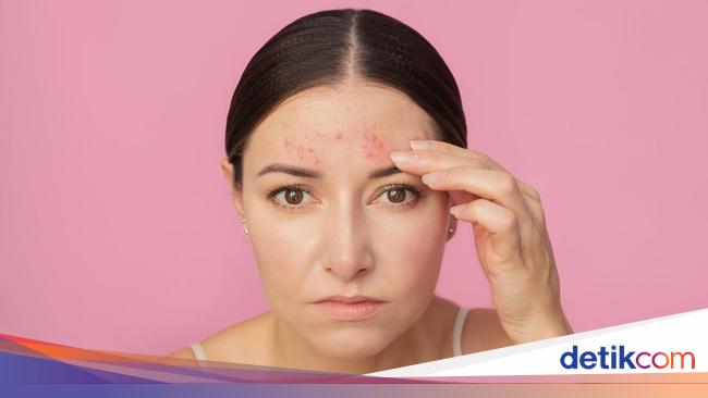 Jerawat di Dahi Disebabkan Oleh Apa? Ini 7 Penyebabnya