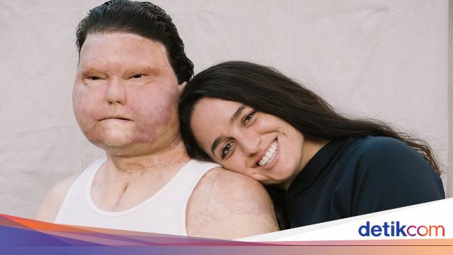 8 Foto Pria Pertama dengan Transplantasi Wajah Bertemu Jodoh, Kini Tunangan