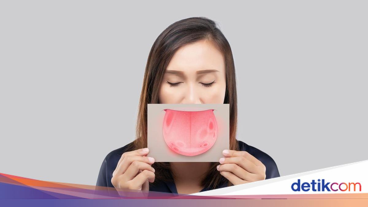 Kenapa Lidah Berwarna Putih? Ini Penyebab dan Cara Mengatasinya