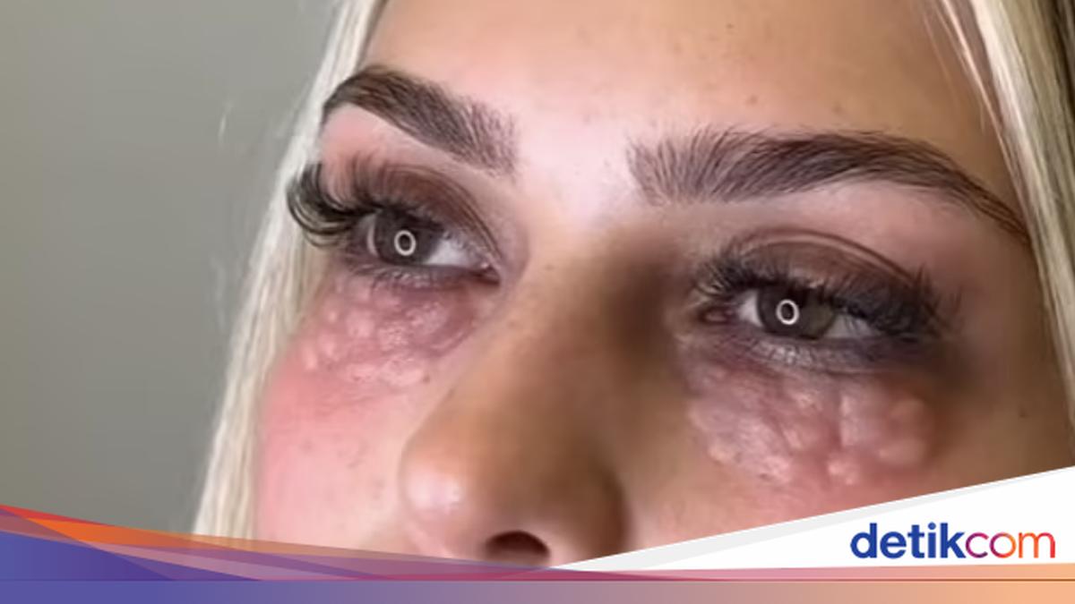 Bahaya Prosedur Kecantikan yang Punya Efek Samping Wajah Seperti Reptil