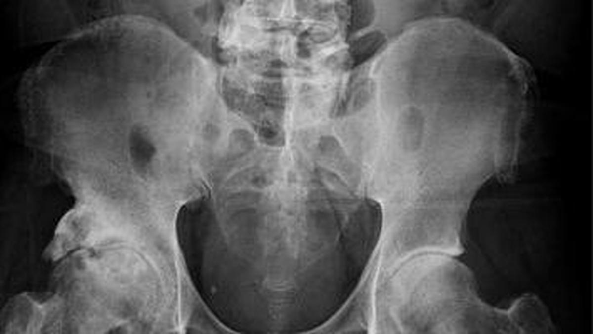 Alami Kondisi Langka, Mr P Pria Ini Mengeras dan 'Bertulang'