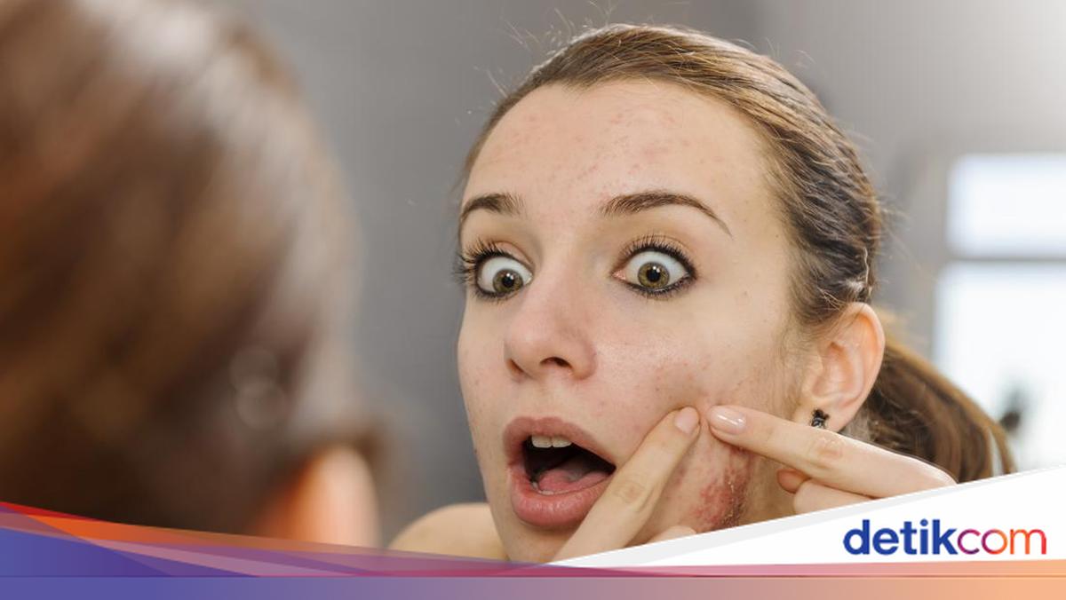 Ini Perbedaan Bisul dan Jerawat yang Perlu Kamu Tahu, Jangan Keliru!
