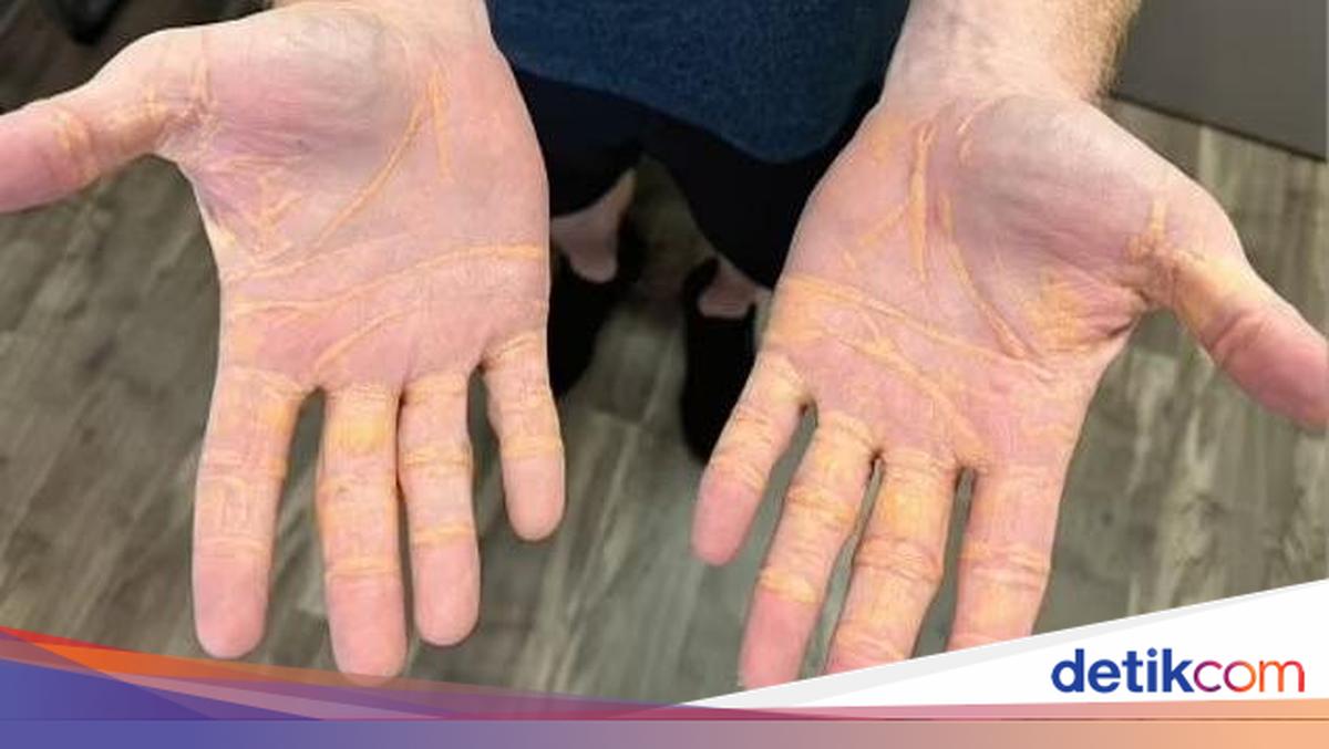 Hanya Makan Daging Sapi dan Keju, Tubuh Pria Ini Penuh Warna Kuning