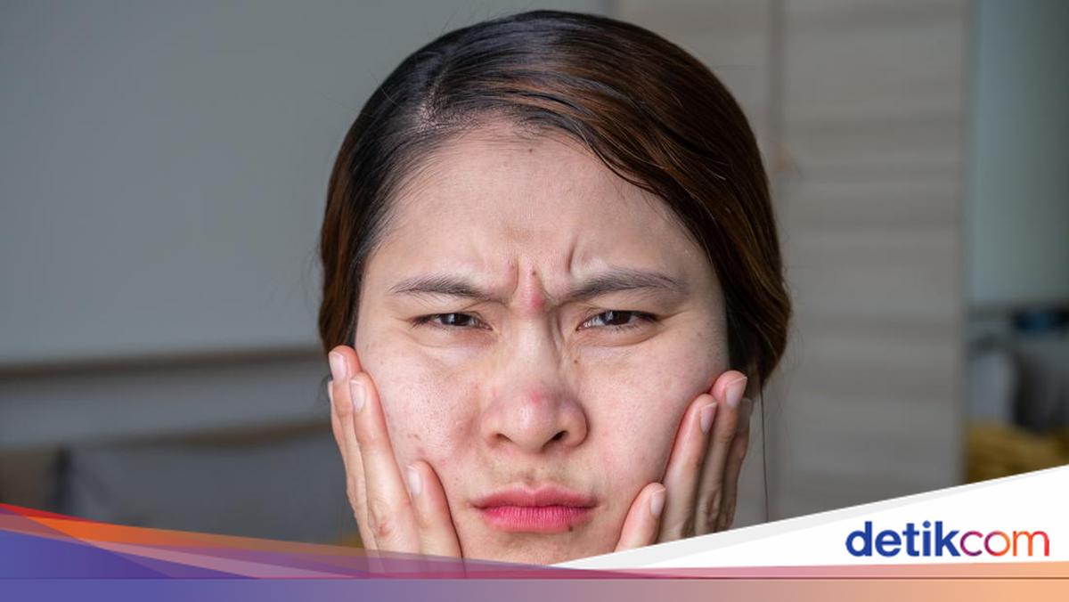 7 Cara Menyembuhkan Jerawat Meradang dari Perawatan Alami hingga Medis