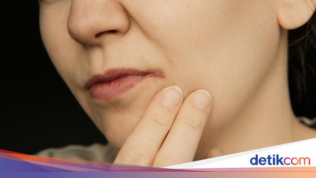 8 Cara Mengatasi Pinggir Bibir Luka dan Kering Saat Puasa