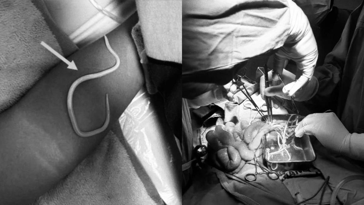 Ngilu, Dokter di Jember Keluarkan Cacing Hidup di Perut Bocah 3 Tahun