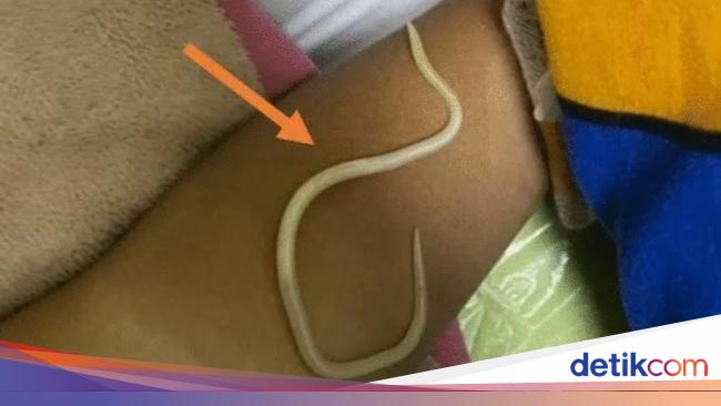 7 Fakta Ngeri 3 Stoples Cacing Bersarang di Perut Bocah 3 Tahun Jember