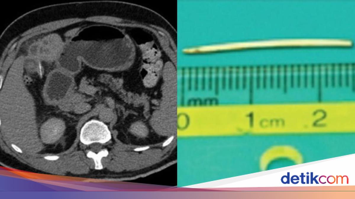 Tak Sengaja Telan Tulang Ikan, Liver Pria Ini Rusak Parah