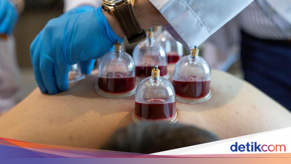 6 Manfaat Bekam untuk Kesehatan dan Efek Sampingnya, Kapan Bekasnya Hilang?