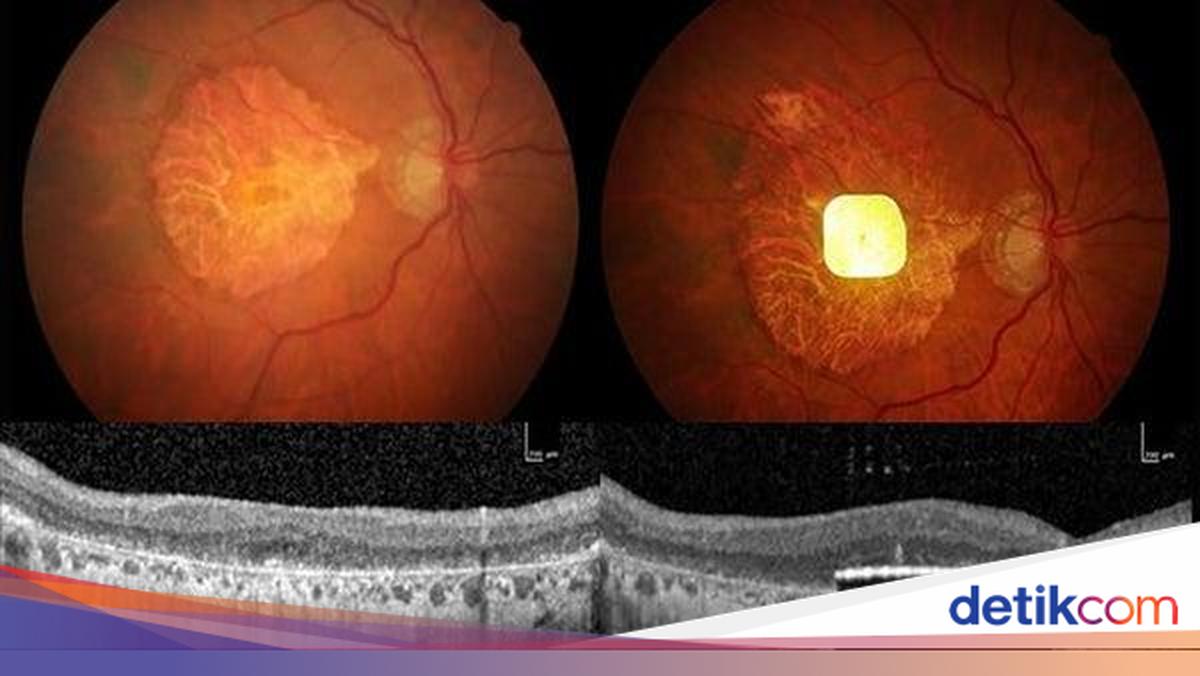 Temuan Chip 'Mata Kecil' oleh Ilmuwan Stanford, Bisa Bantu Orang Buta ...