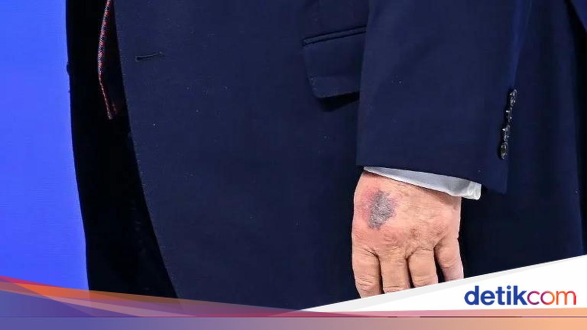 Trump Jelaskan Kondisi Tangannya yang Jadi Sorotan karena Memar