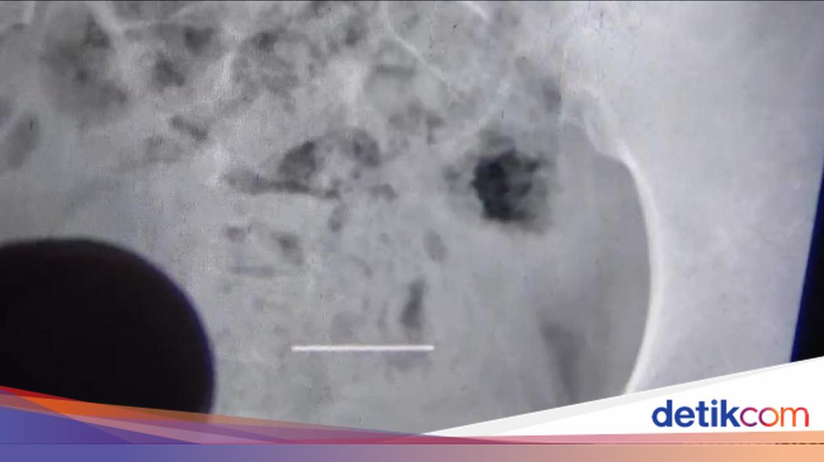 Jarum Pentul Tertelan, Remaja Sumedang Dilarikan ke RS