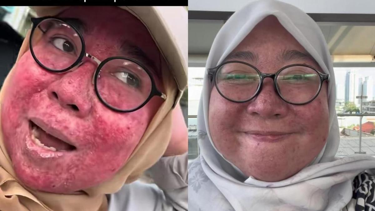 Wanita Jaksel Breakout Parah, Alami Gejala Ini Pasca Stop Skincare Steroid