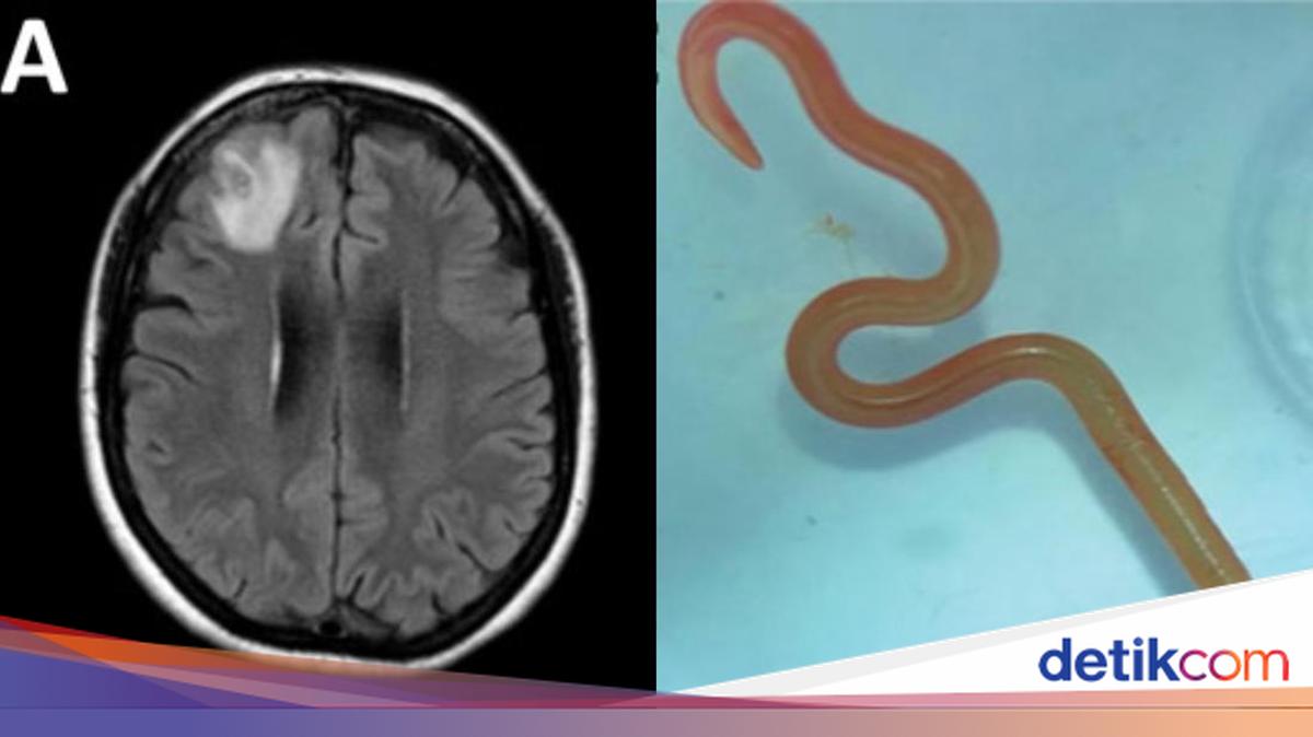 Mengerikan! Dokter Temukan Parasit Ular Piton 8 Cm di Otak Manusia