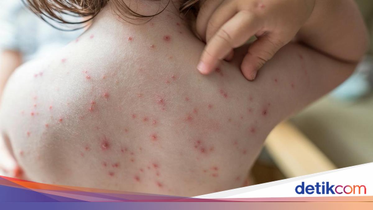 Campak Bukan Pembersihan Tubuh! Simak Fakta Medis dan Bahaya Komplikasinya