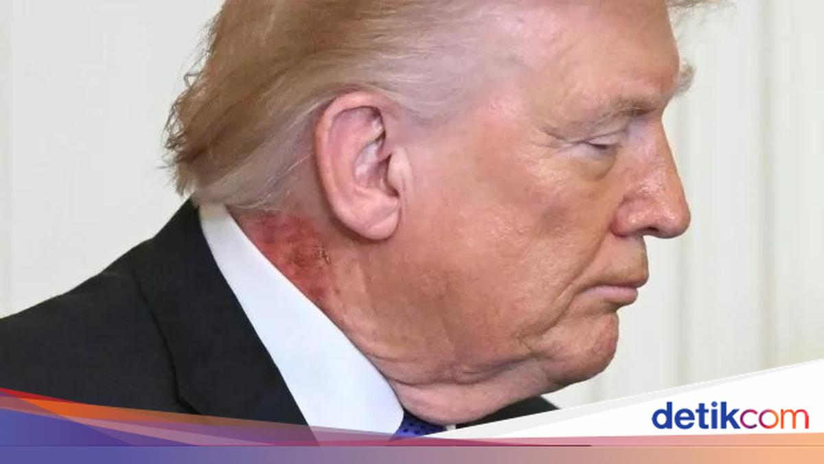 Heboh Ada Ruam Merah di Leher Trump, Kesehatannya Jadi Sorotan