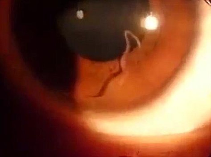 Ketika Cacing Gelang Masuk ke Tubuh Manusia dan 'Bersarang' di Mata