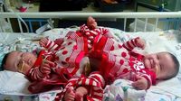 Bayi Kembar Dempet Pinggul yang Langka Asal AS Akhirnya Terpisahkan