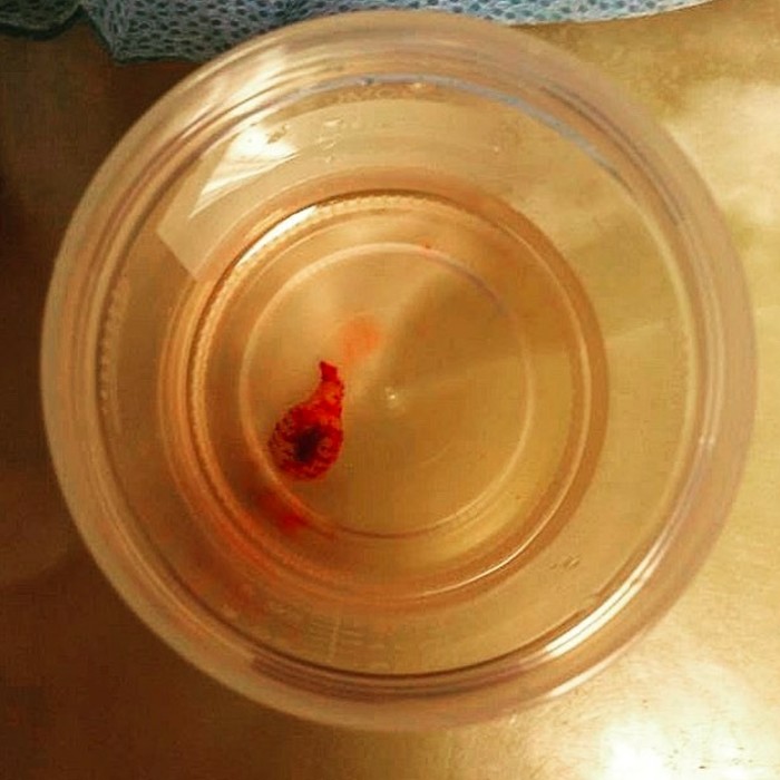 Potret Belatung Parasit di Tubuh Ini Bikin Merinding!