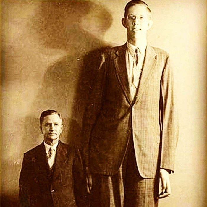 Potret Mereka yang Tidak Bisa Berhenti Tumbuh Karena Gigantisme