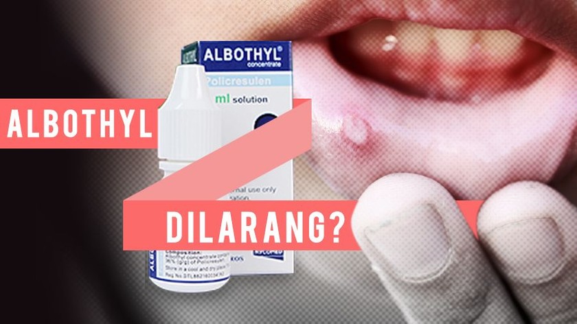 Albothyl Dilarang, Ini Saran PDGI untuk Obati Sariawan