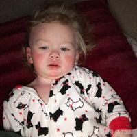 Foto: Ivy Angerman, Bocah Umur 18 Bulan Yang Mengidap Alergi Air Langka