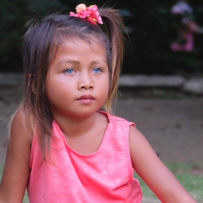 Aww Mata Biru Menyala Penyandang Sindrom Waardenburg