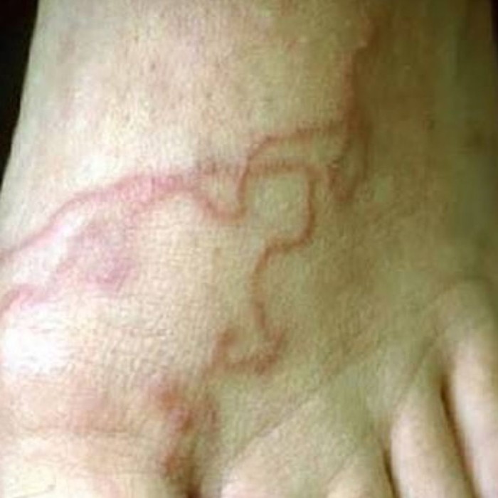 Pernah Temukan Luka Seperti Ini? Tanda Ada Cacing Parasit di Kulit